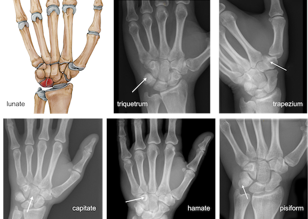 Carpal Bone Fracture